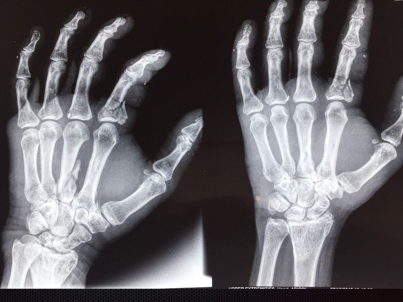 Polytrauma Management