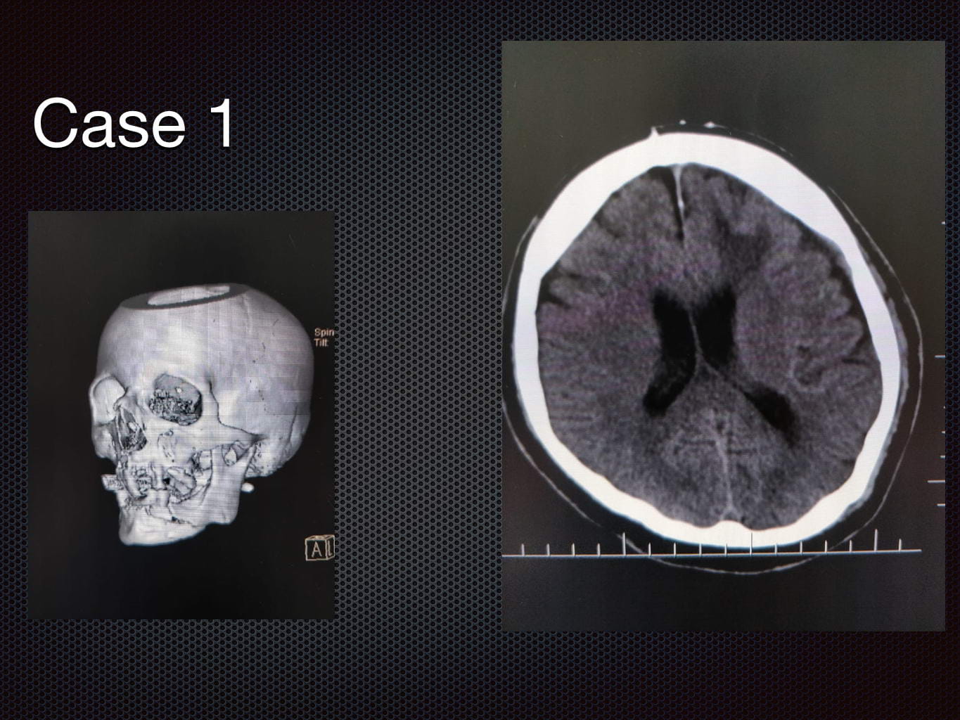 Polytrauma Management