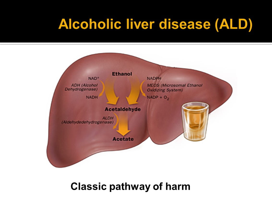 Alcoholic Liver Disease