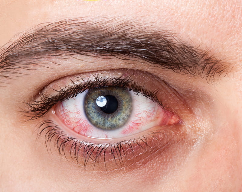 Acute Red Eye: Differential Diagnosis