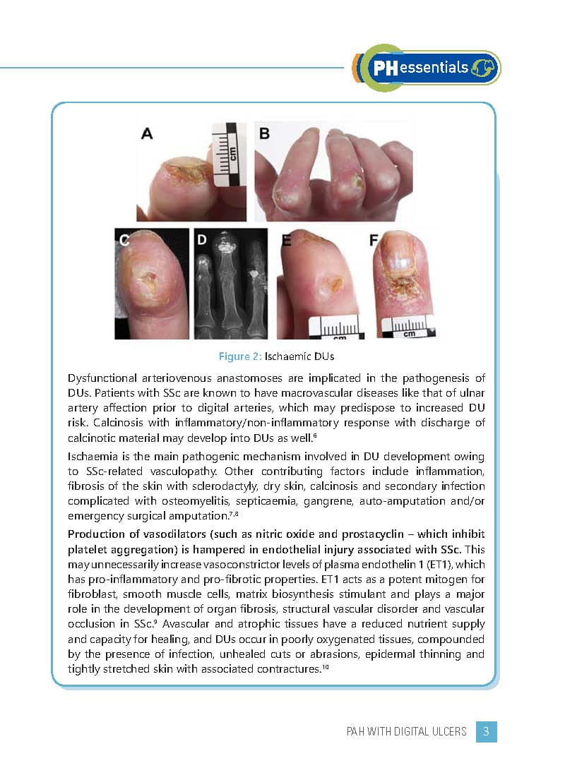 Pulmonary Arterial Hypertension in Digital Ulcers